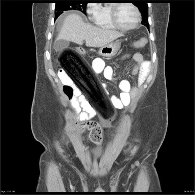 Website Compiles X-Ray Photos Of Weird Things Stuck Up People's Butts