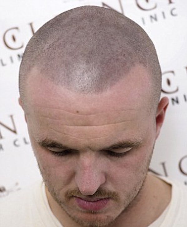 Some Bald Men Are Getting Tattoos So It Looks Like They Have Hair (Photos)