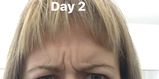 I Did Botox And The Pics Of My Transformation Are Insane