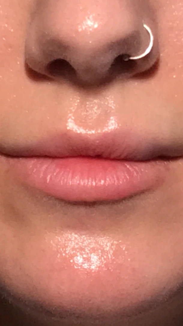 I Got Fillers To Cure RBF & They Actually Turned My Frown Upside Down